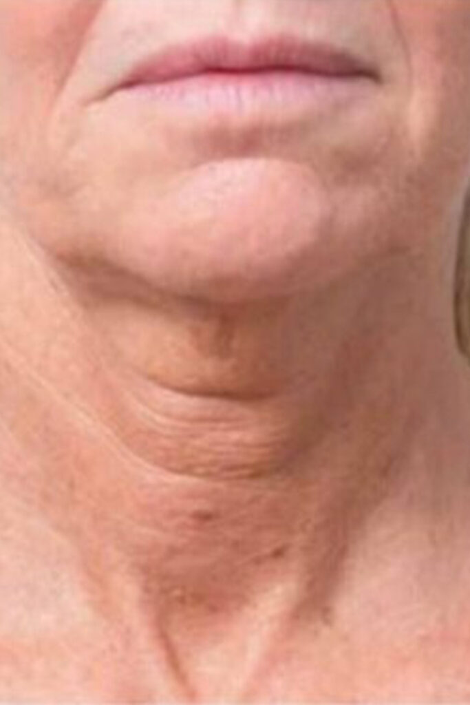 Profhilo Treatment | Profhilo® injections | Skin Treatments