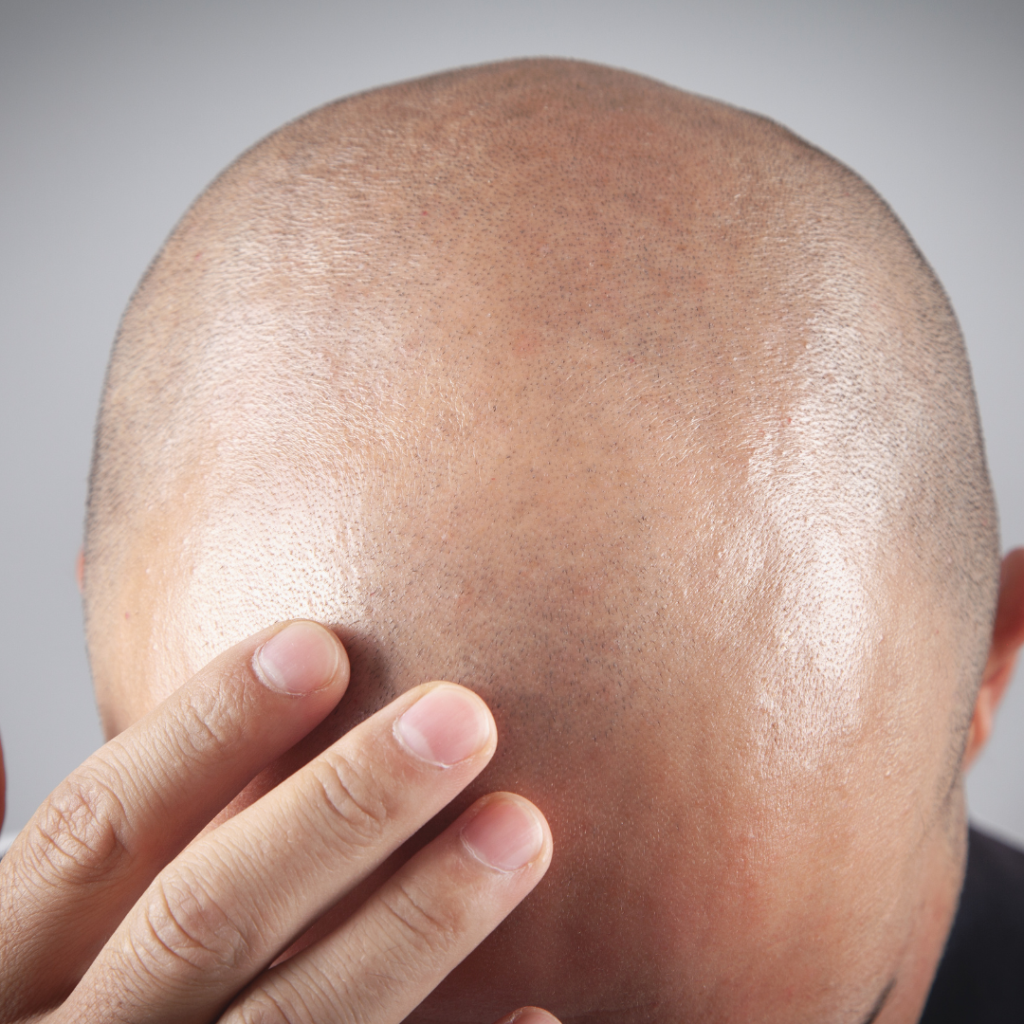 Scalp Micropigmentation Removal in Birmingham | SMP Treatment