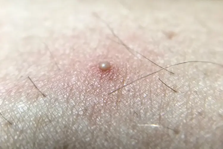 Laser Hair Removal | Folliculitis | Victoria House Clinic